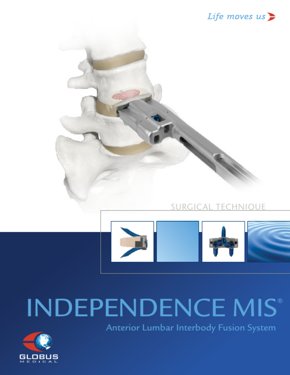 INDEPENDENCE MIS Anterior Lumbar Interbody Fusion System PDF download